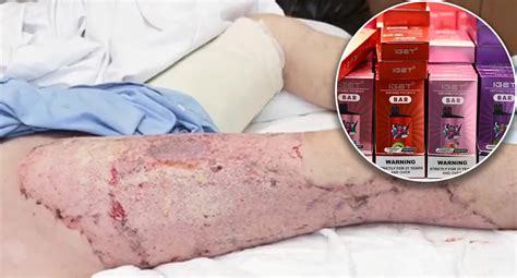 Perth Mans Horrific Injuries After Vape Explodes In His Pocket