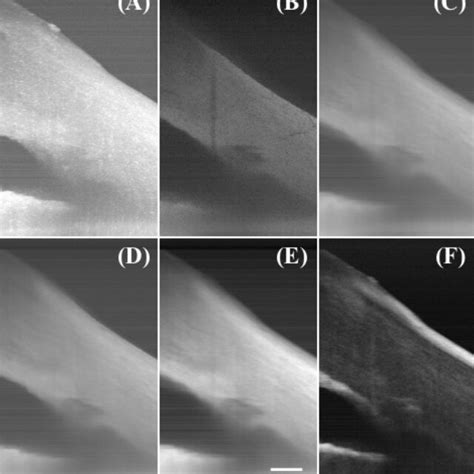 high resolution iridocorneal angle oct imaging segmentation and