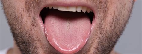 La Macroglossia O Lingua Grossa Cosè E Quali Sono Le Cause