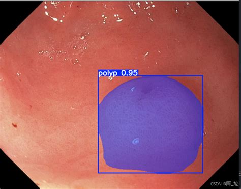 基于yolo11深度学习的胃肠道息肉智能检测分割与诊断系统【python源码pyqt5界面数据集训练代码】深度学习实战、目标分割、人工