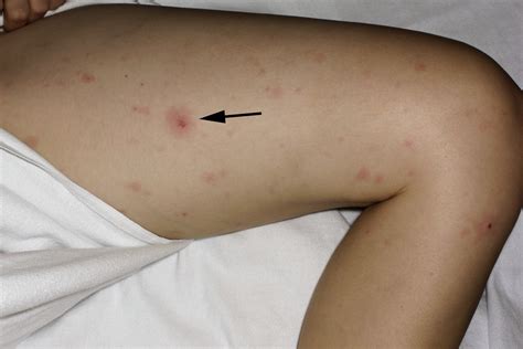 A Menacing Maculopapular Rash Journal Of Emergency Medicine