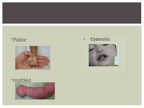 Pediatric Assessment Triangle Ppt