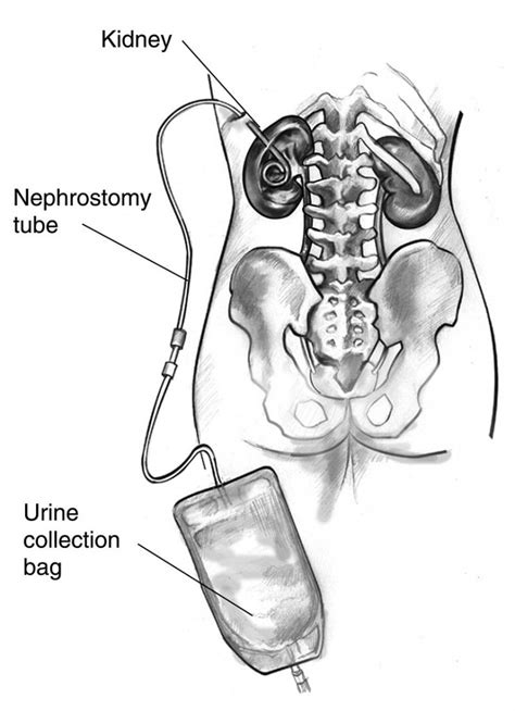 Difference Between Nephrostomy And Urostomy Nephrostomy Vs Urostomy