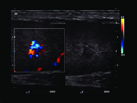Ultrasound Revealed A Hypoechoic Mass And Color Doppler Showed The Download Scientific Diagram