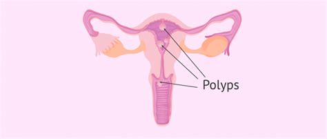 What Is Polypectomy Dewanrudra Medium