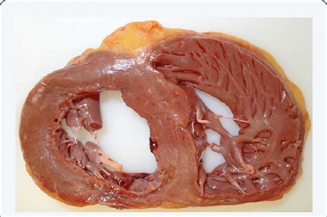 Thinning Of The Left Ventricular Wall And Rupture Myocardial
