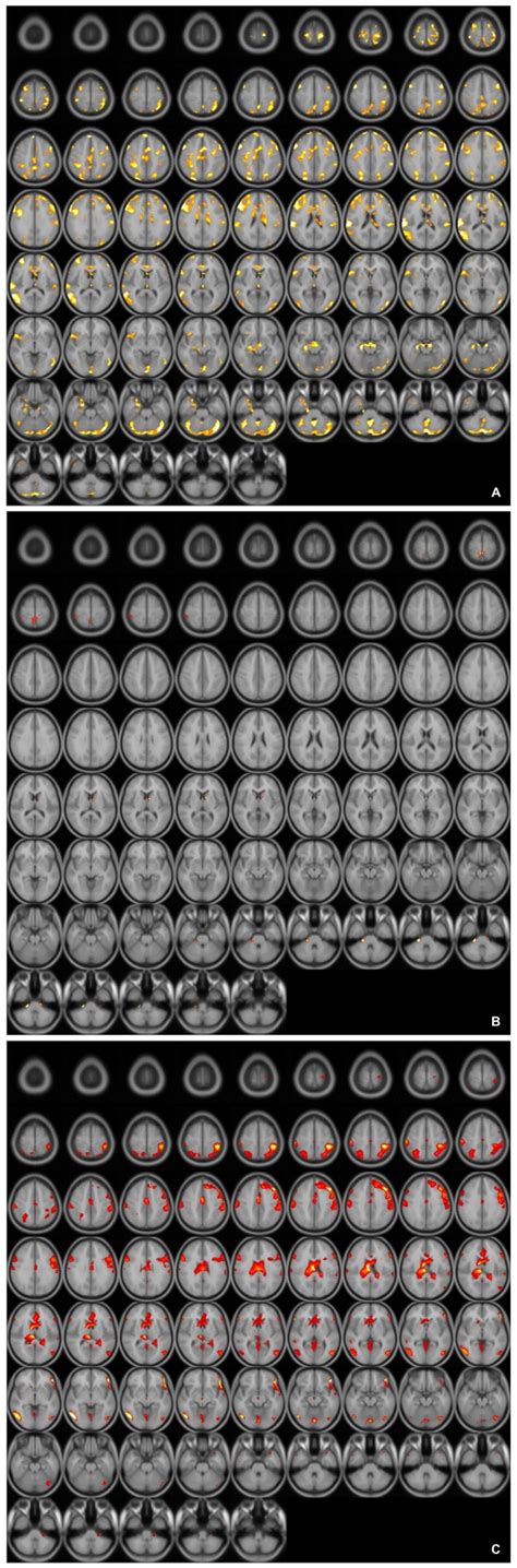A Axial View Of Activated Brain Areas By Erotic Visual Stimuli In Download Scientific Diagram