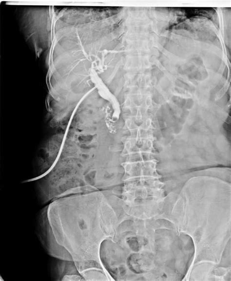 T Tube Cholangiogram