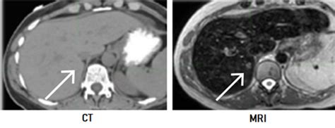 MR Linac Advances In Radiation Therapy