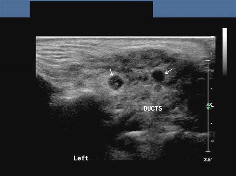 Parotid Duct Stone Ultrasound