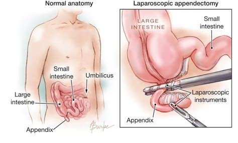Appendix Removal Appendectomy Best Doctors Free Consultation