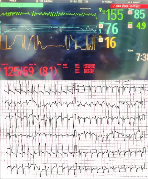 Upper Panel Shows Monitor Electrocardiographic Trace With Ventricular Download Scientific