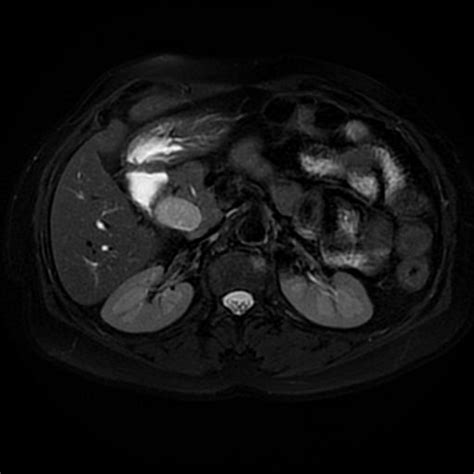 Cholangiocarcinoma Radiopaedia Cholangiocarcinoma Radiology Case