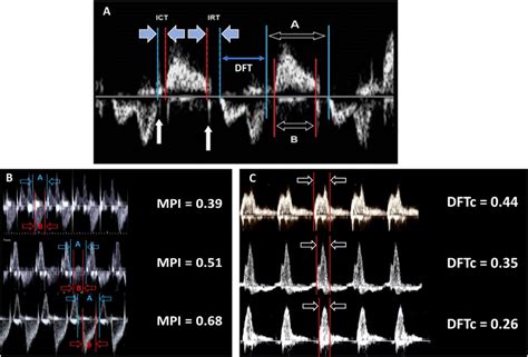 Myocardial Performance Index MPI And Diastolic Filling Time DFT