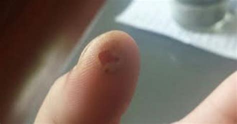 Blood Blister Under A Blister Imgur