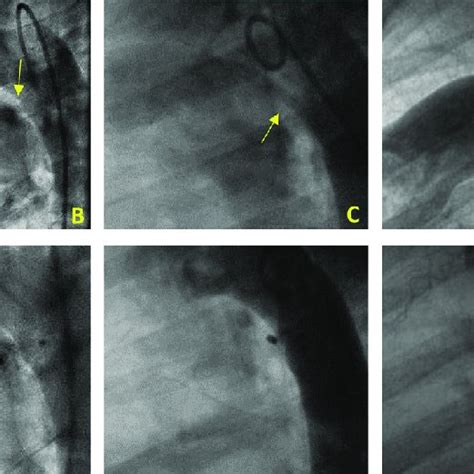 Pda Morphological Types And Devices Arrows Indicate Pdatop Panel Download Scientific Diagram