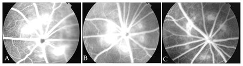 Interactions Between Endostatin And Vascular Endothelial Growth Factor Vegf And Inhibition Of