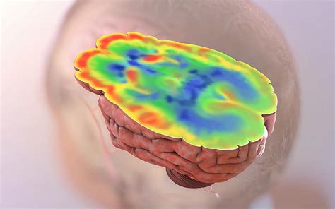 Higher Brain Glucose Levels May Mean More Severe Alzheimers Nih Intramural Research Program