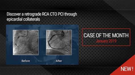 Video Retrograde Rca Cto Pci Through Epicardial Collaterals