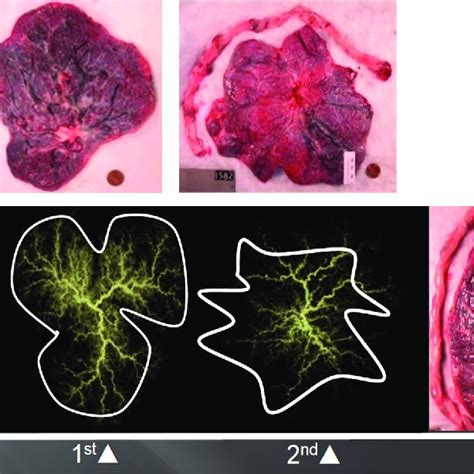 Varieties Of Placental Shape Abnormalities And Time Of Origin Based On Download Scientific