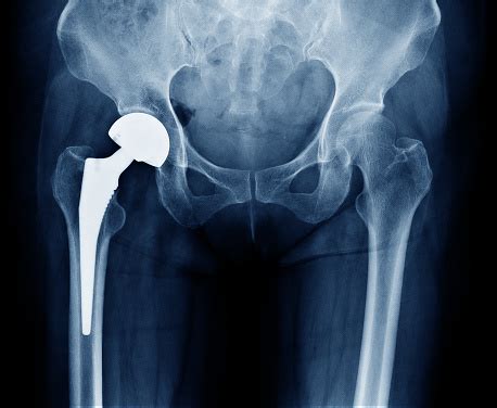 Xray Scan Image Of Hip Joints With Orthopedic Hip Joint Replacement Or