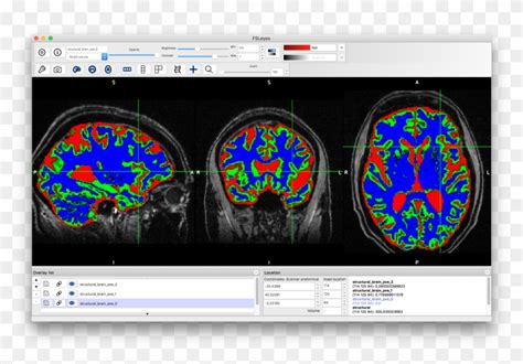 Each Pve Image Represents The Partial Volume Estimate Hd Png Download 2816x18445688355