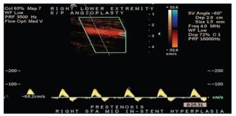 L E Arterial Waveforms And Abis Flashcards Quizlet