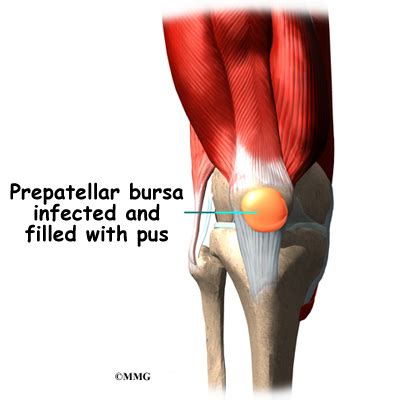 Prepatellar Bursitis