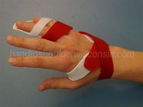 Hand To Shoulder Center Of Wisconsin Dupuytrens Contracture