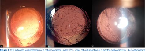 Posterior Capsular Opacification Diagnosis Code At Rose Thyer Blog