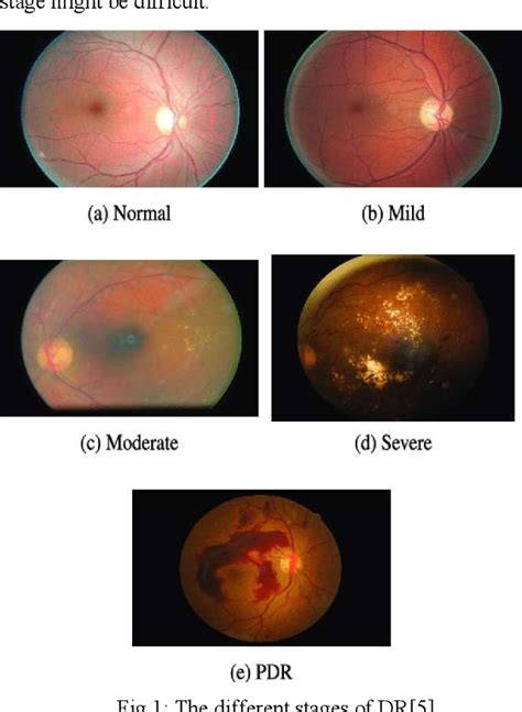 Figure 1 From Detection And Classification Of Diabetic Retinopathy Using Pretrained Deep Neural