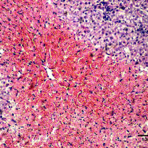 Liver Diffuse Reticular Pattern Associated With Centrilobular Necrosis