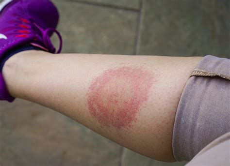 Tick Bite Fever Recovery Time