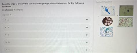 Solved An HIV Positive Patient Who Just Had A CSF Sample Chegg Com