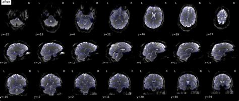 Fsl S Topup Implementation Fmriprep Significantly Worse Than Afni S Qwarp Fmriprep
