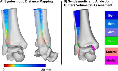 Distal Tib Fib Joint
