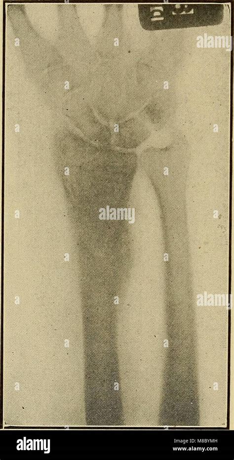 A Medical Text From 1914 Detailing Various Diseases Affecting Bones And Joints Including Their