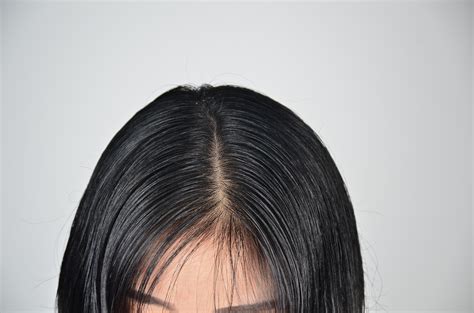 头皮干货油屑敏感星人，到底应该如何自救？ 知乎
