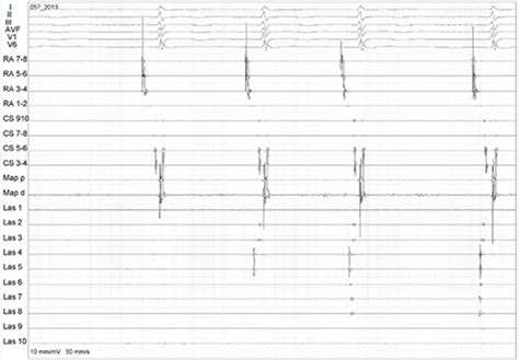 Complete Isolation Of The Left Atrial Posterior Wall Box Lesion To Treat Longstanding