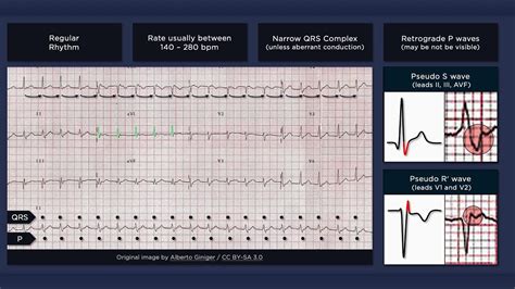 Atrioventricular Nodal Re Entry Tachycardia Avnrt Ecg Youtube