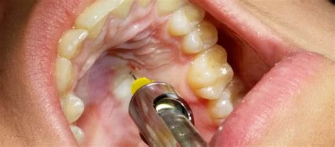 Amsa The Magical Palatal Injection