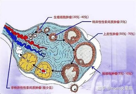 它是妇科常见的多发病，患者5年生存率仅30 左右 知乎