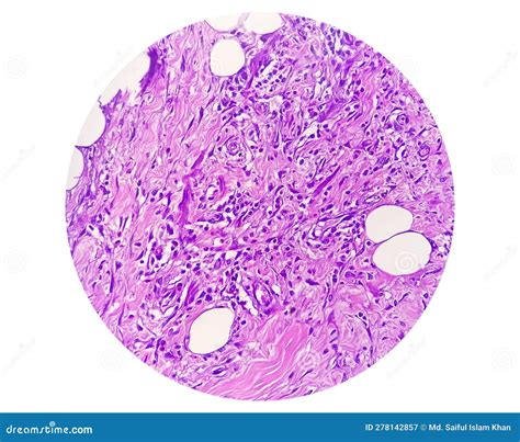 Photomicrograph Of Granulomatous Tissue Histolog