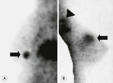 Radionuclide And Hybrid Imaging Radiology Key