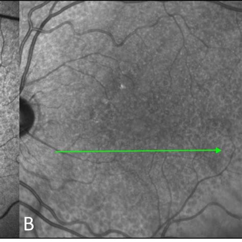 Imaging Of Reticular Pseudodrusen Example Of Reticular Pseudodrusen Download Scientific