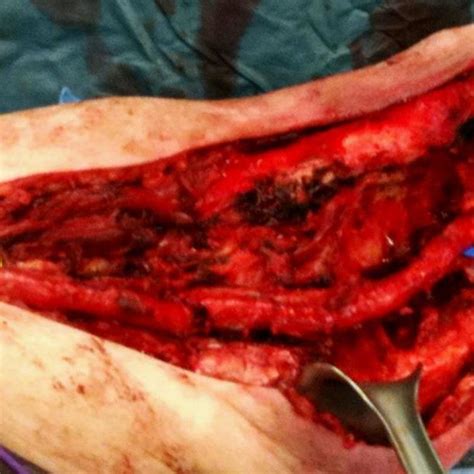 Intraoperative Image With The Femoral Vessels After The Sarcoma Removal