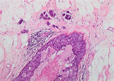 The Presentation Management And Outcome Of Patients With Ductal Carcinoma In Situ Dcis With