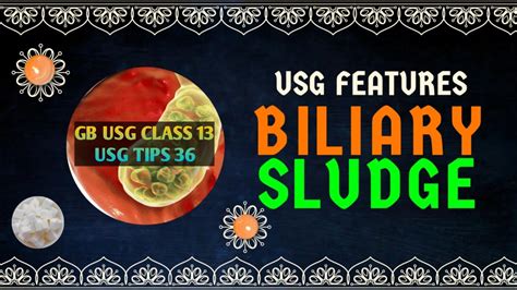 Usg Tips Sonic Features Of Biliary Sludge And Tumefactive Sludgeultrasound Radiology