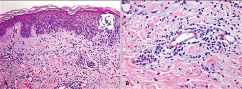 Figure 2 From Two Cases Of Pruritic Urticarial Papules And Plaques Of Pregnancy In The