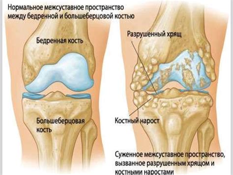 Артроз коленного сустава гонартроз деформирующий артроз презентация онлайн
